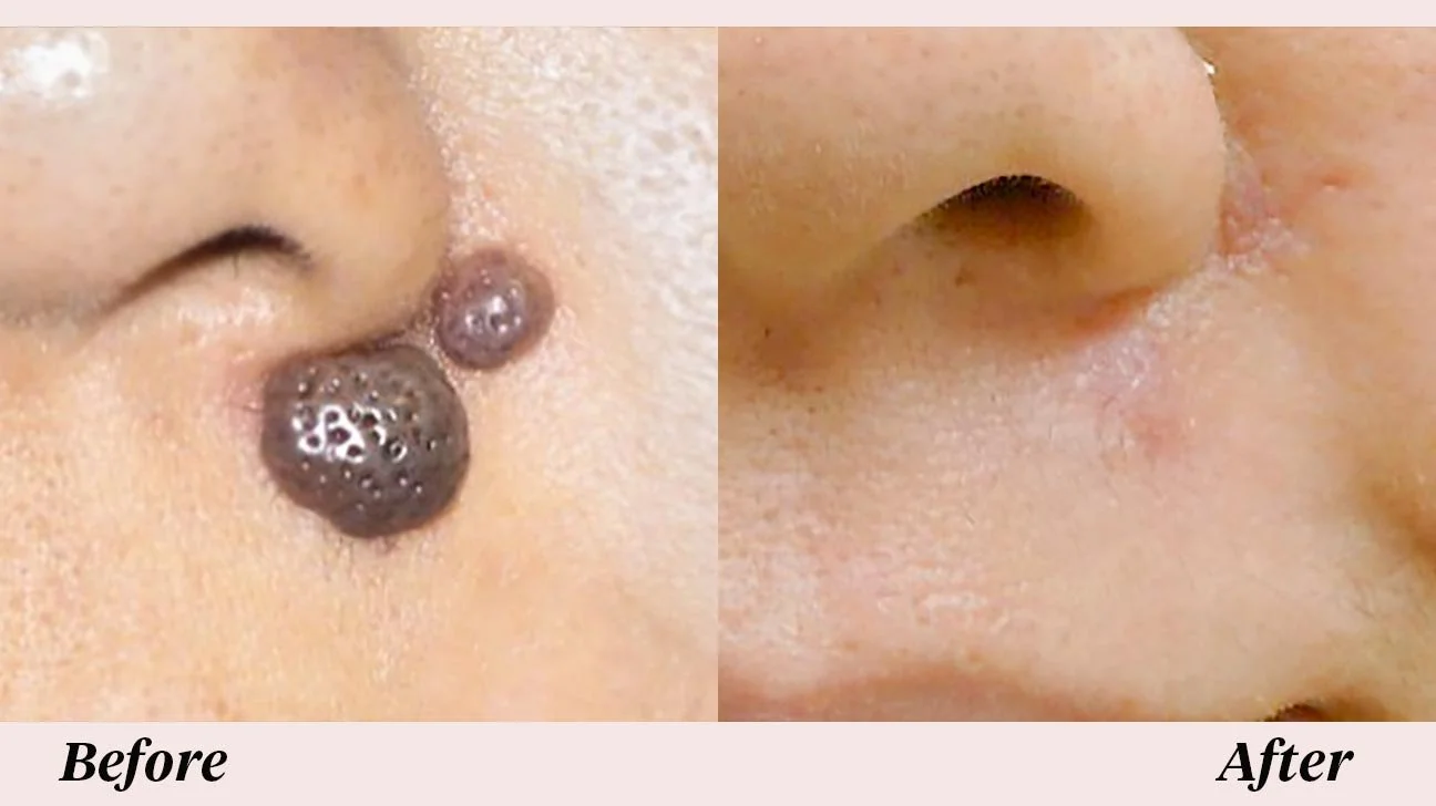 Mole Removal in Edmonton, Calgary & Grande Prairie — Alberta ...