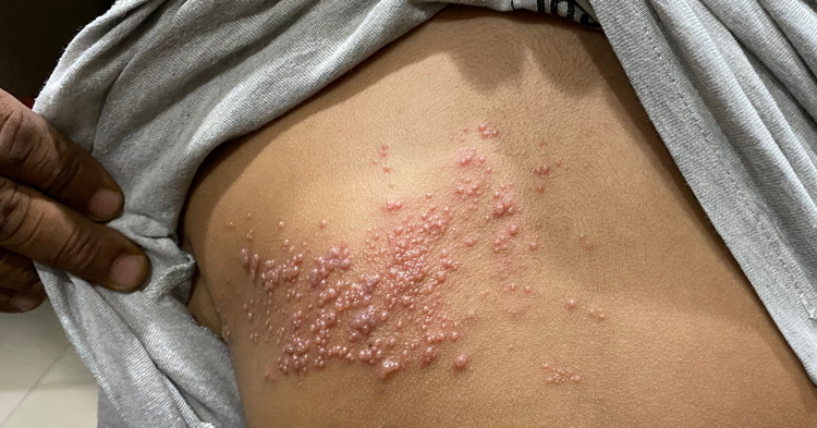 Shingles in Seniors: Recognizing Symptoms and Care Strategies — Ca Care ...