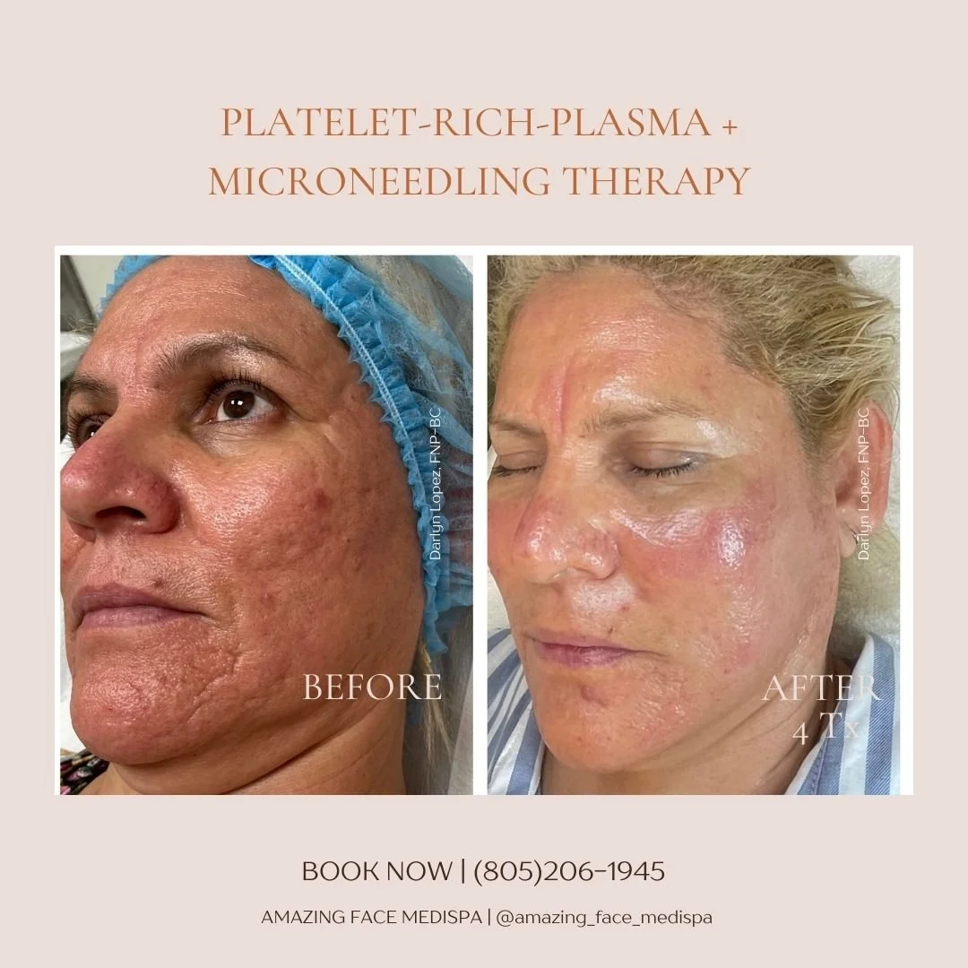 Before & After Aesthetic Injection Xeomin Lip Filler Radiesse Kybella ...