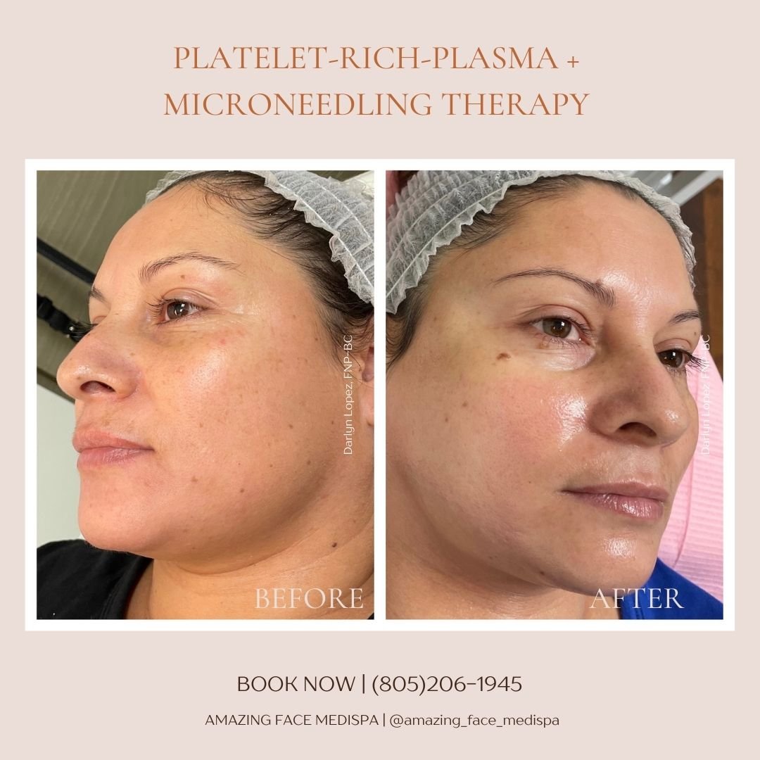 Before And After Aesthetic Injection Xeomin Lip Filler Radiesse Kybella