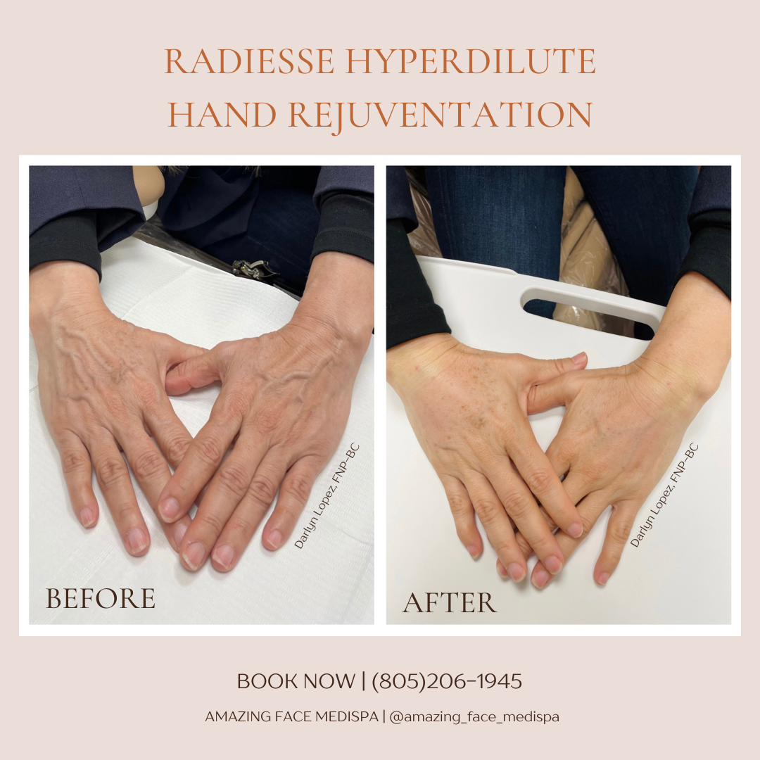 Before & After Aesthetic Injection Xeomin Lip Filler Radiesse Kybella ...