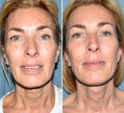 Maiorino Plastics - Face Gallery