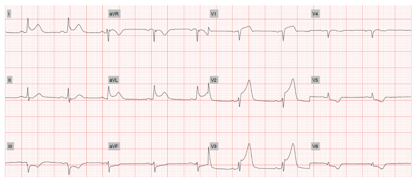 CASE: the importance of serial clinical assessments and ECGs — Manitoba ...