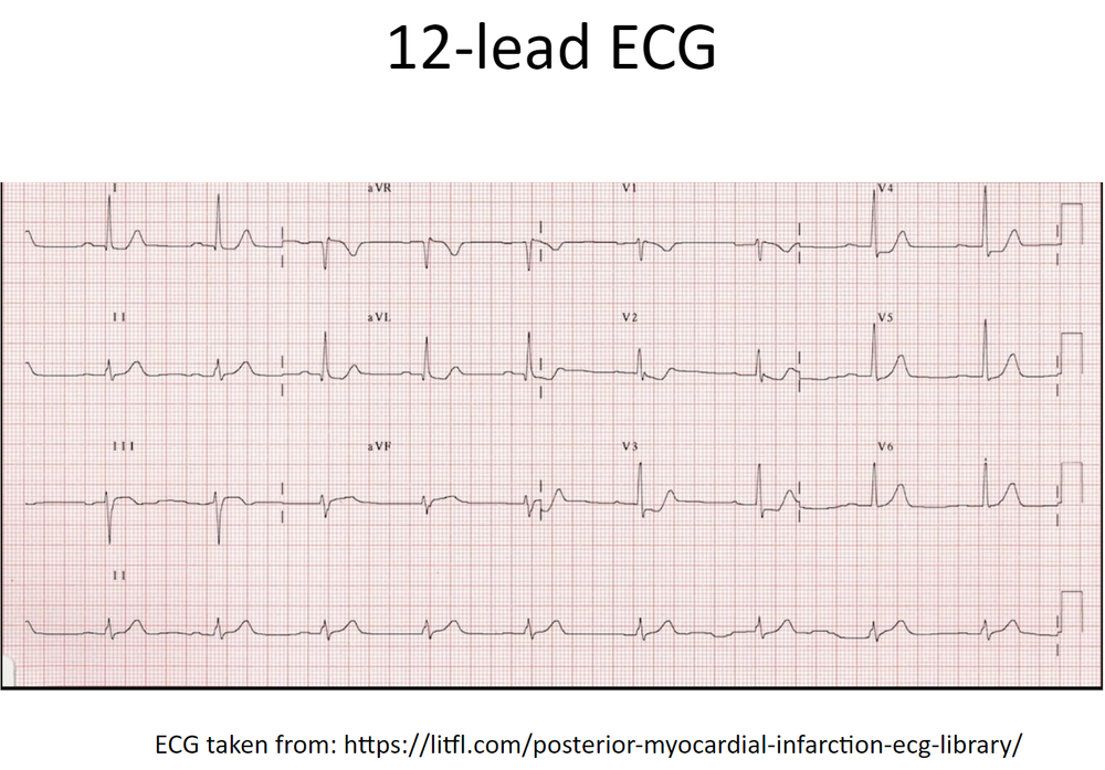 ECG Case: Posterior STEMI — Manitoba ACS Network