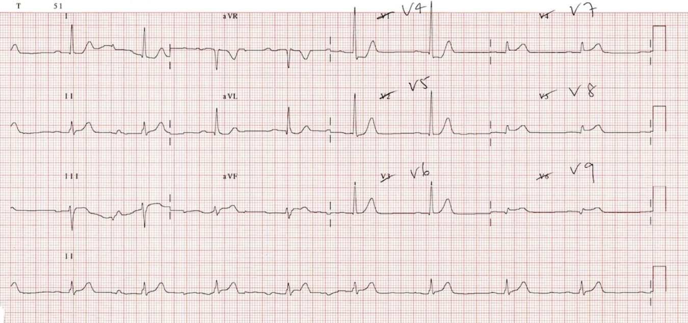 ECG Case: Posterior STEMI — Manitoba ACS Network
