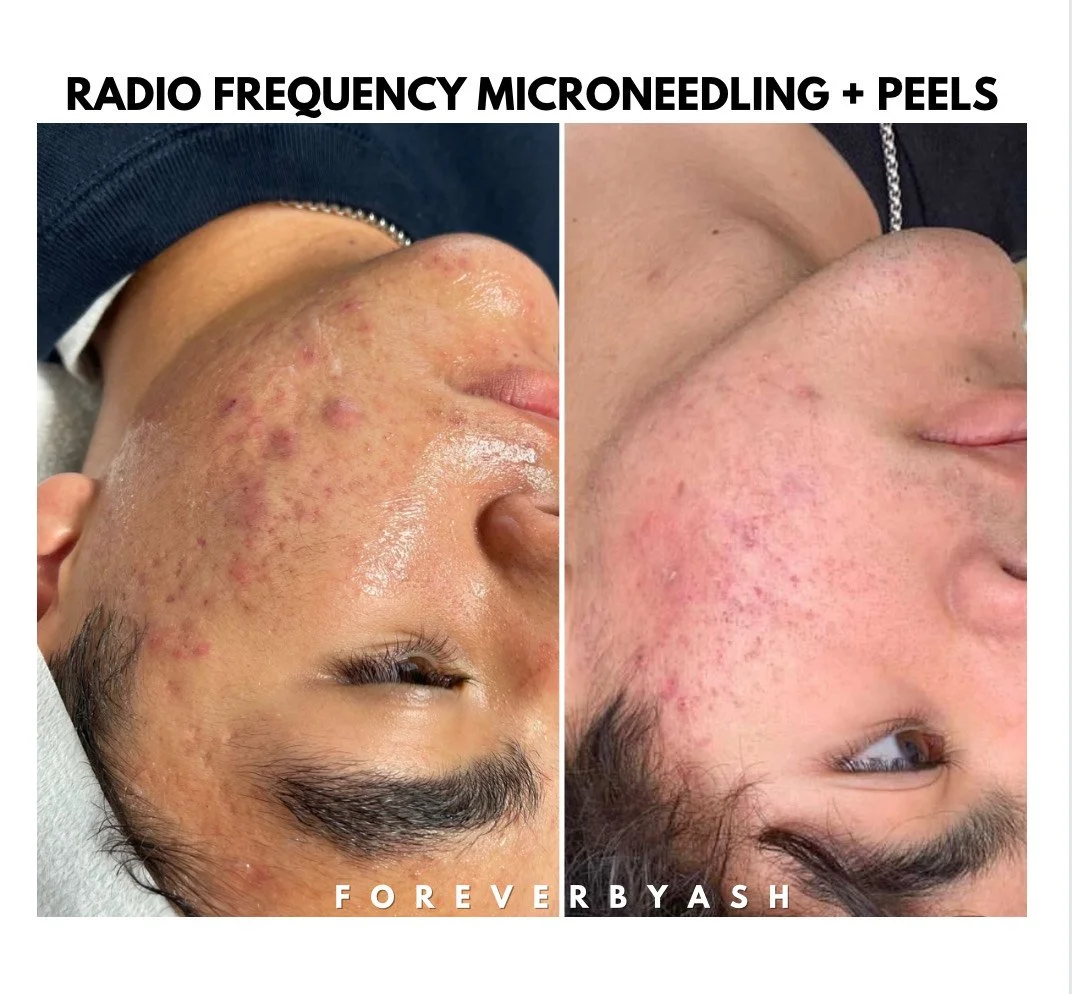 ForeverByAsh Facials — FBA Skin (Foreverbyash)