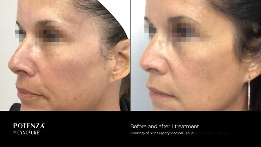Potenza™ RF Microneedling in Kelowna — External Affairs