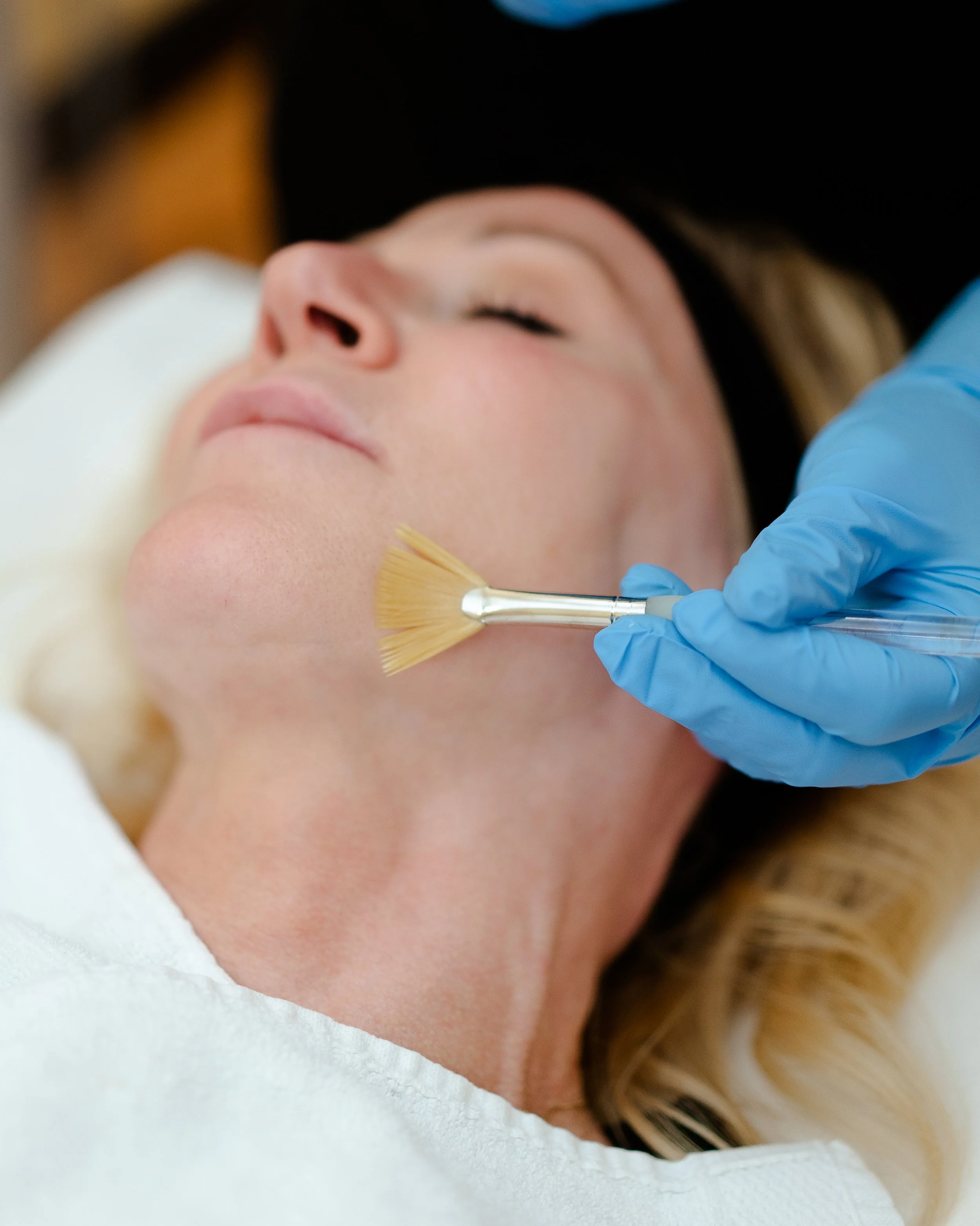 Chemical Peels in Edmonton, St. Albert and Kelowna — External Affairs