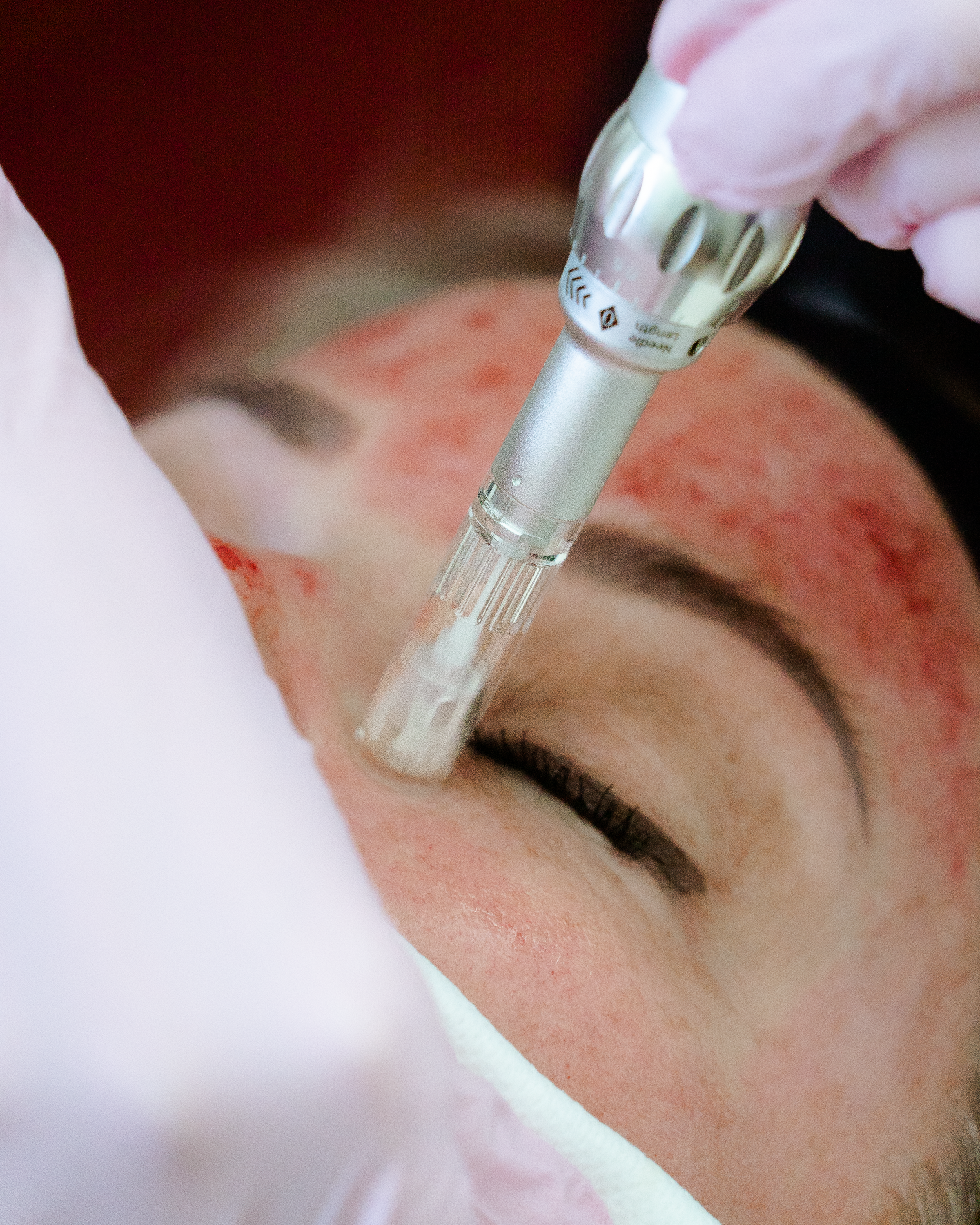 Vampire Facial — External Affairs