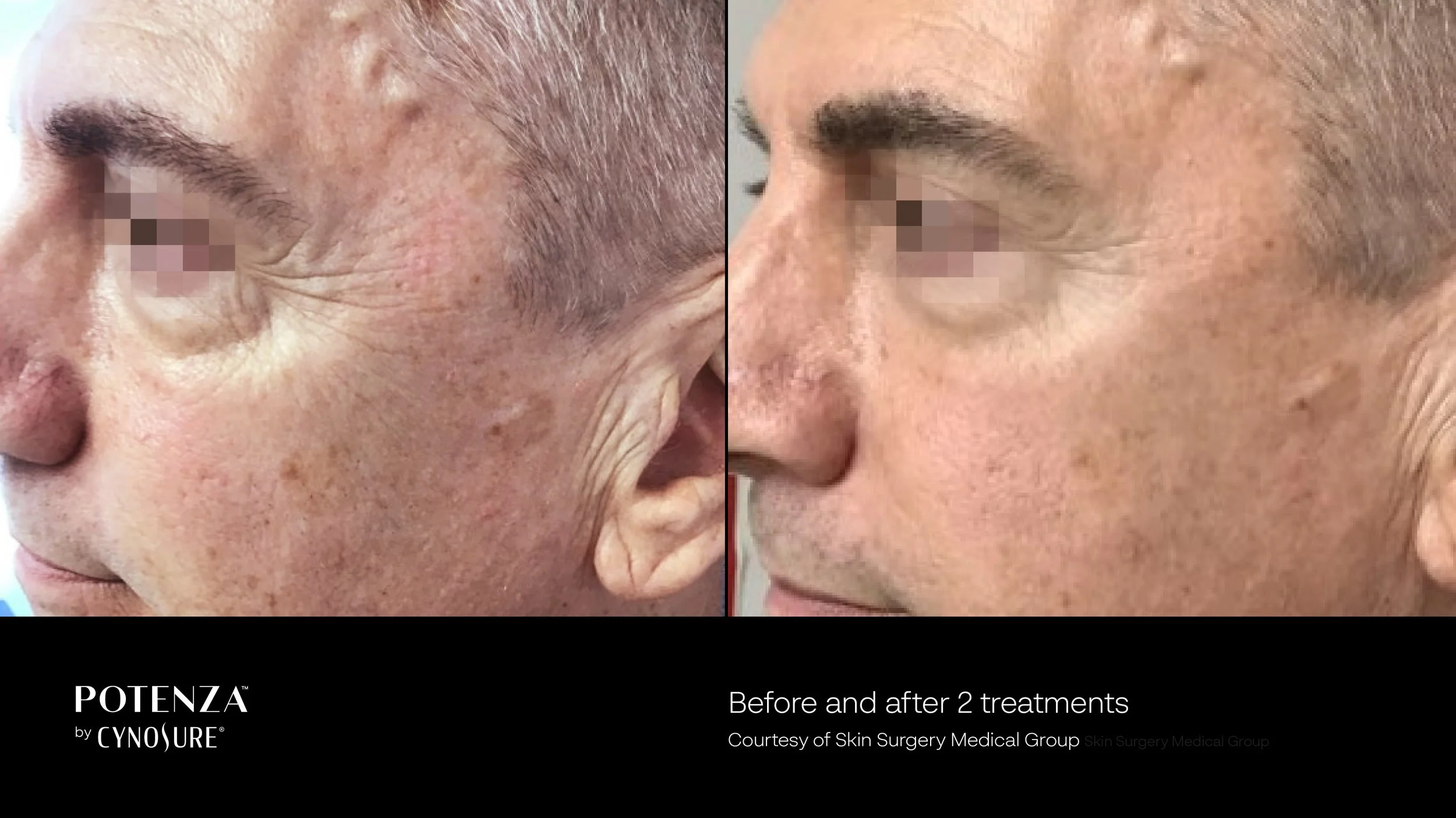 Potenza™ RF Microneedling in Kelowna — External Affairs