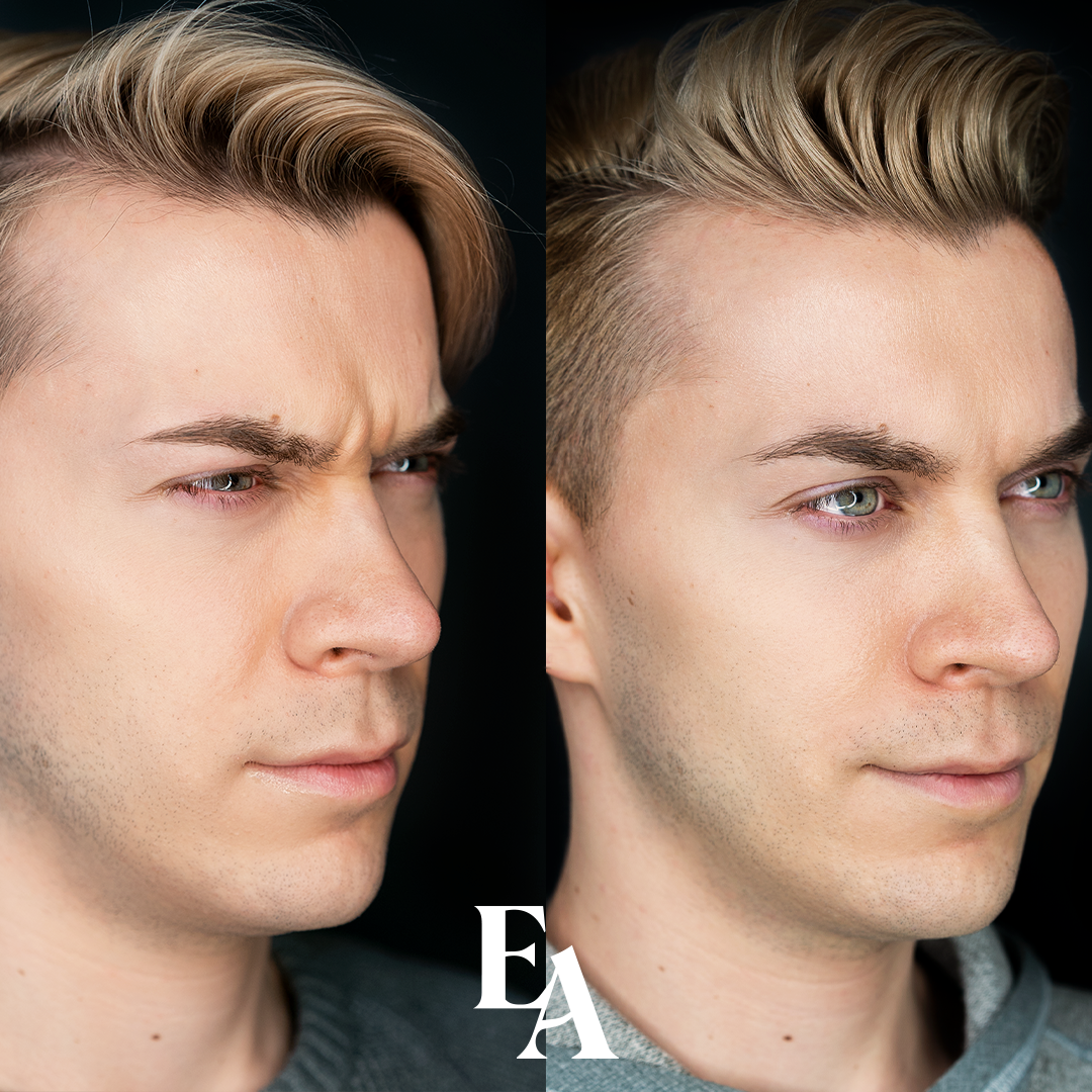 Botox® + Dysport® in Edmonton, St. Albert & Kelowna — External Affairs