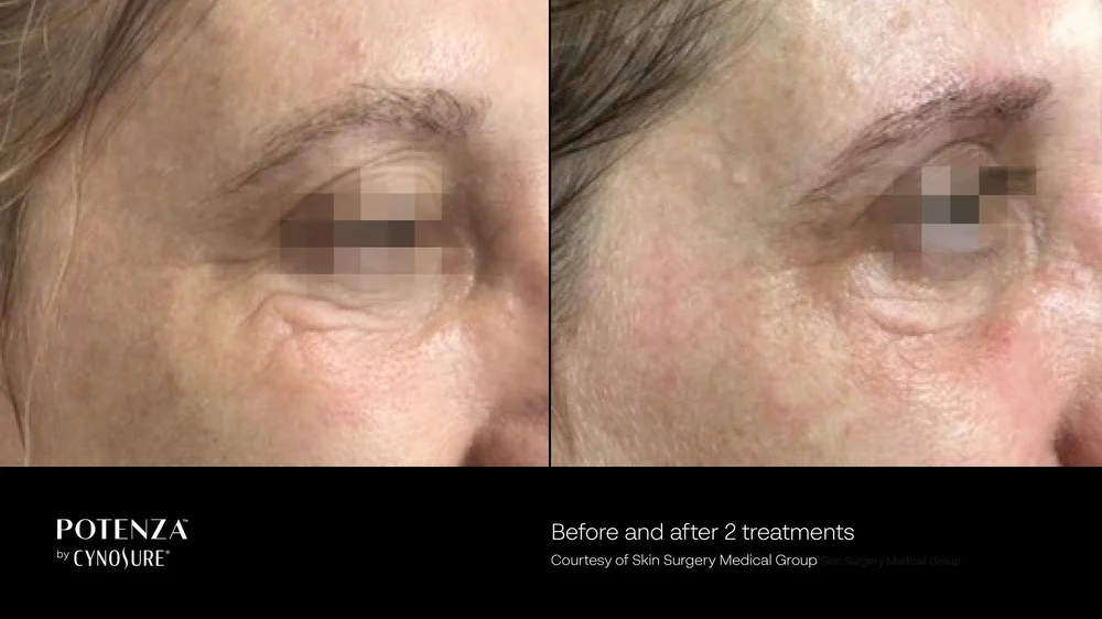 Potenza™ RF Microneedling in Kelowna — External Affairs