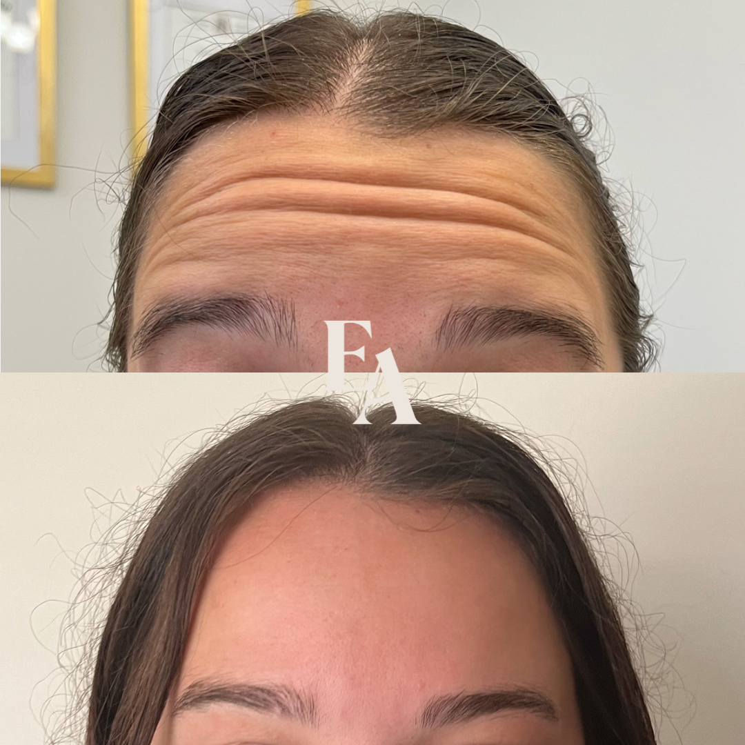 Botox® + Dysport® in Edmonton, St. Albert & Kelowna — External Affairs