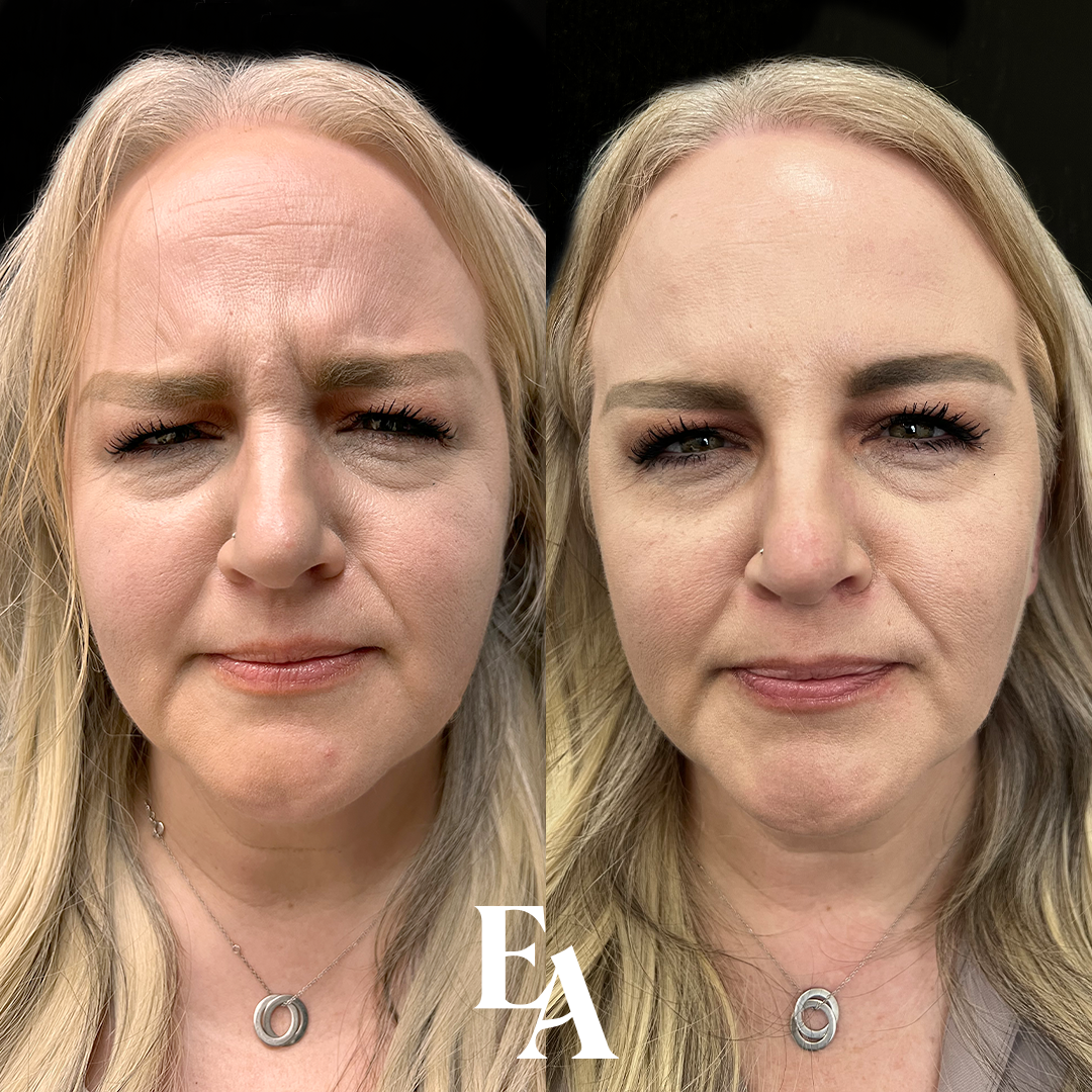Botox® + Dysport® in Edmonton, St. Albert & Kelowna — External Affairs