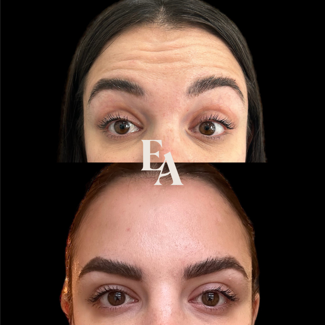 Botox® + Dysport® in Edmonton, St. Albert & Kelowna — External Affairs