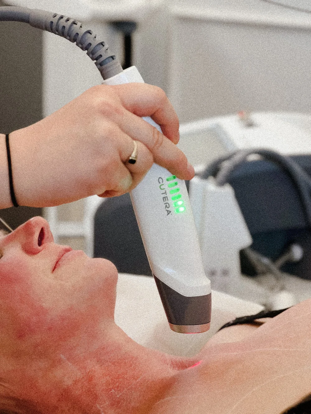 Remove redness, veins, rosacea and more with Excel® V+ in Edmonton ...