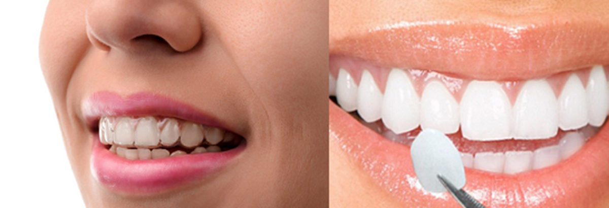 Invisalign Vs Veneers Which Option Is Best For You — Las Vegas