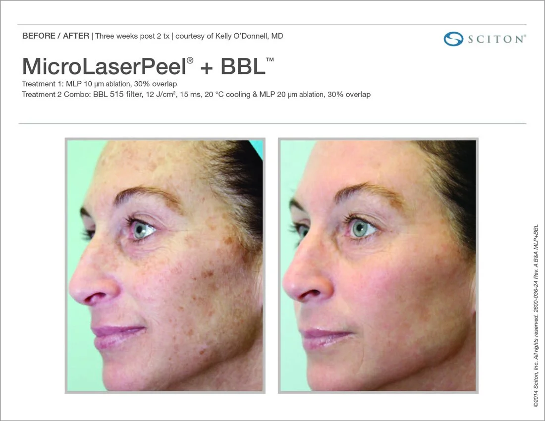Micro/Nano Laser Peel — Sirena Medical Aesthetics