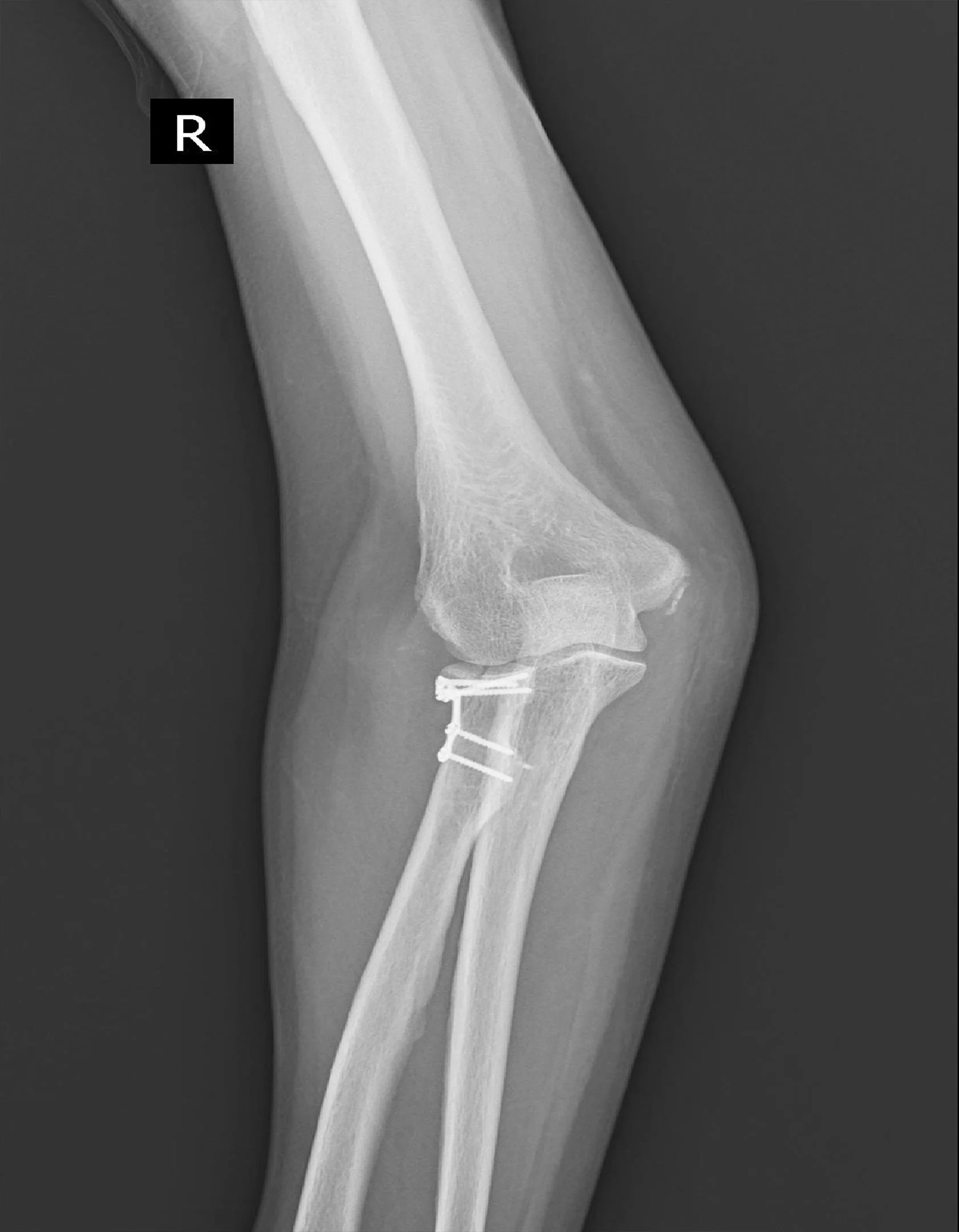 Radial Head Fractures — Dr Jeevaka (Jay) Amaranath | Orthopaedic Upper ...
