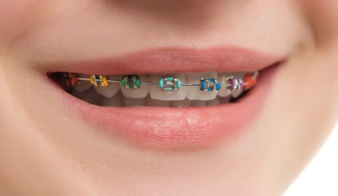 Tips for fixing problems with braces | Pure Orthodontics
