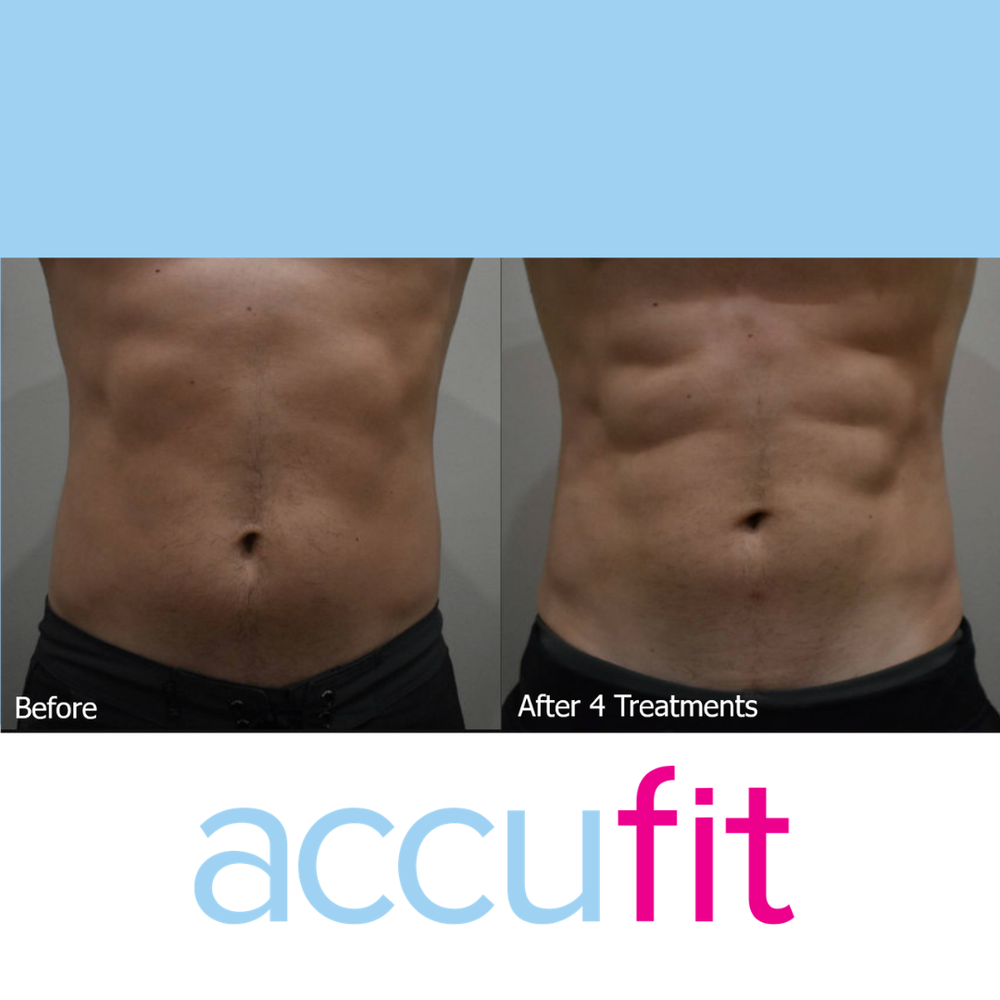 AccuFit Therapy | Texas Cryoworks Total Wellness Center | Non-Invasive ...