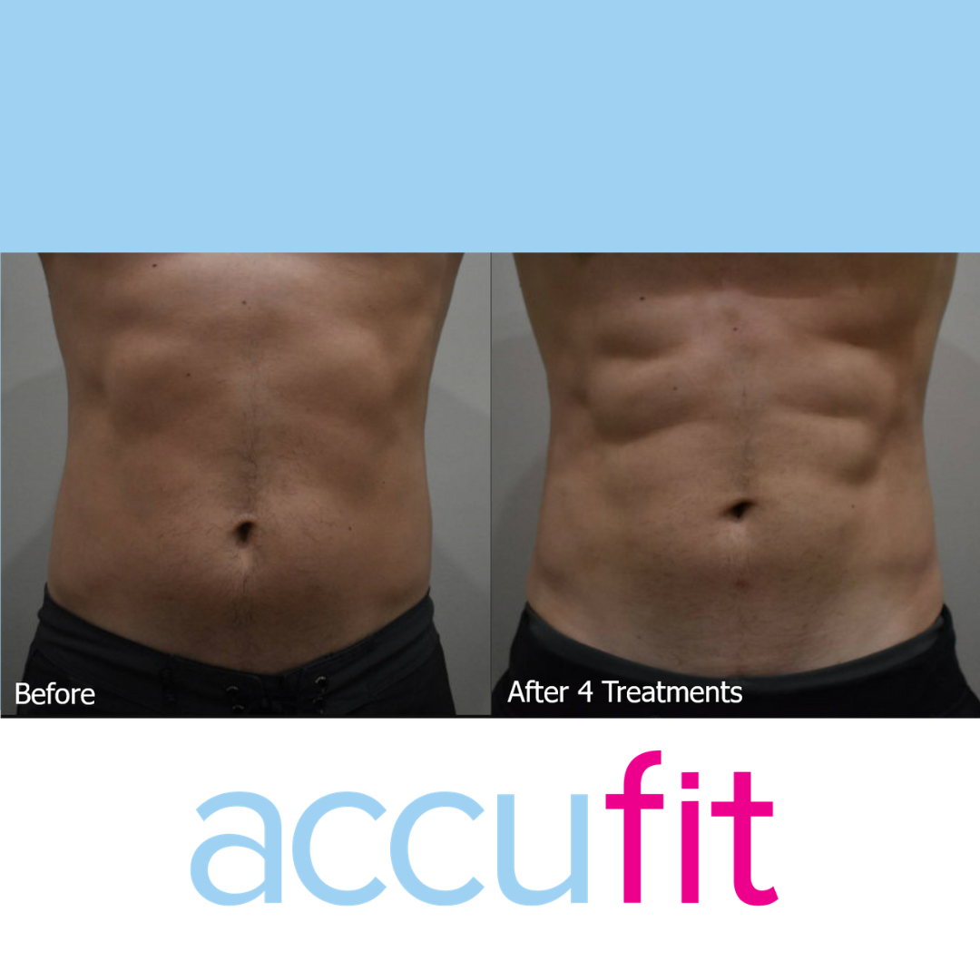 AccuFit Therapy | Texas Cryoworks Total Wellness Center | Non-Invasive ...