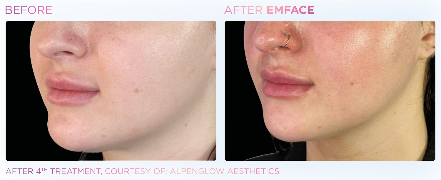 EMFACE Treatment | Texas Cryoworks Total Wellness Center | Non-Invasive ...