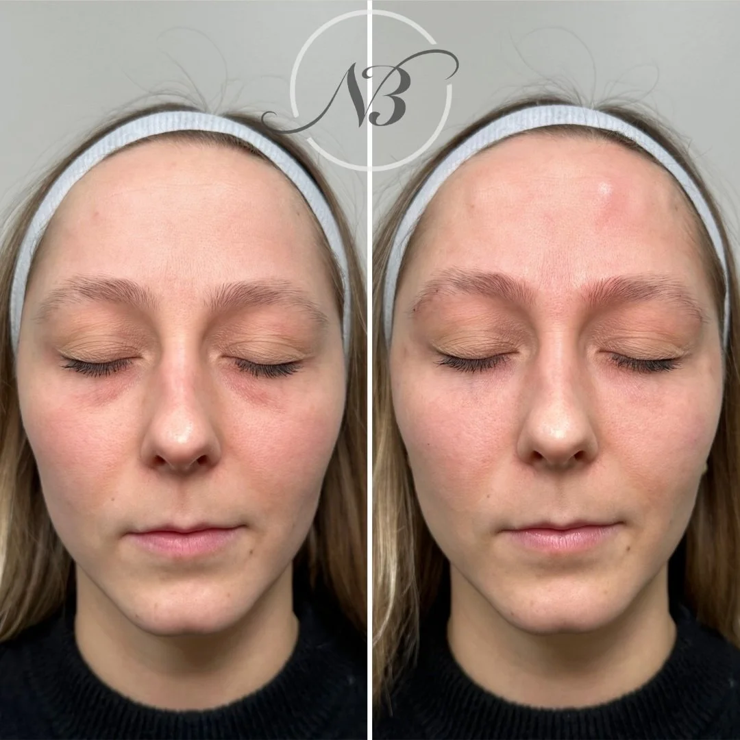 Natural Injections — NuBella Med Spa