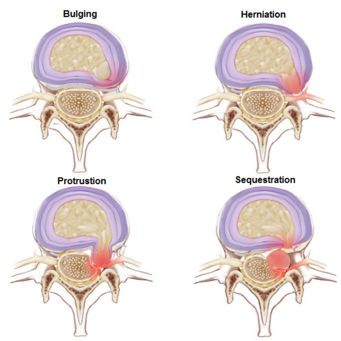Vertebral Disc Injuries: What They Are, Grades of Injury & How We Can ...