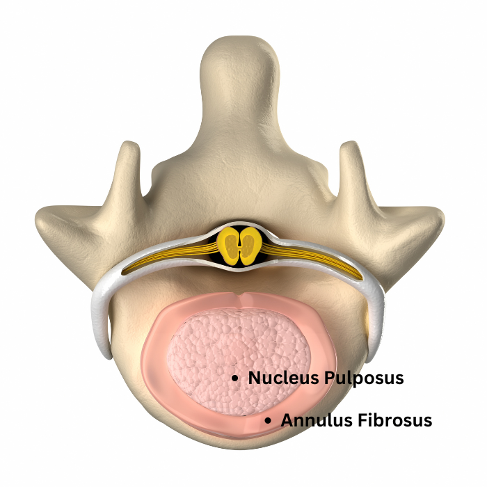 Vertebral Disc Injuries: What They Are, Grades of Injury & How We Can ...