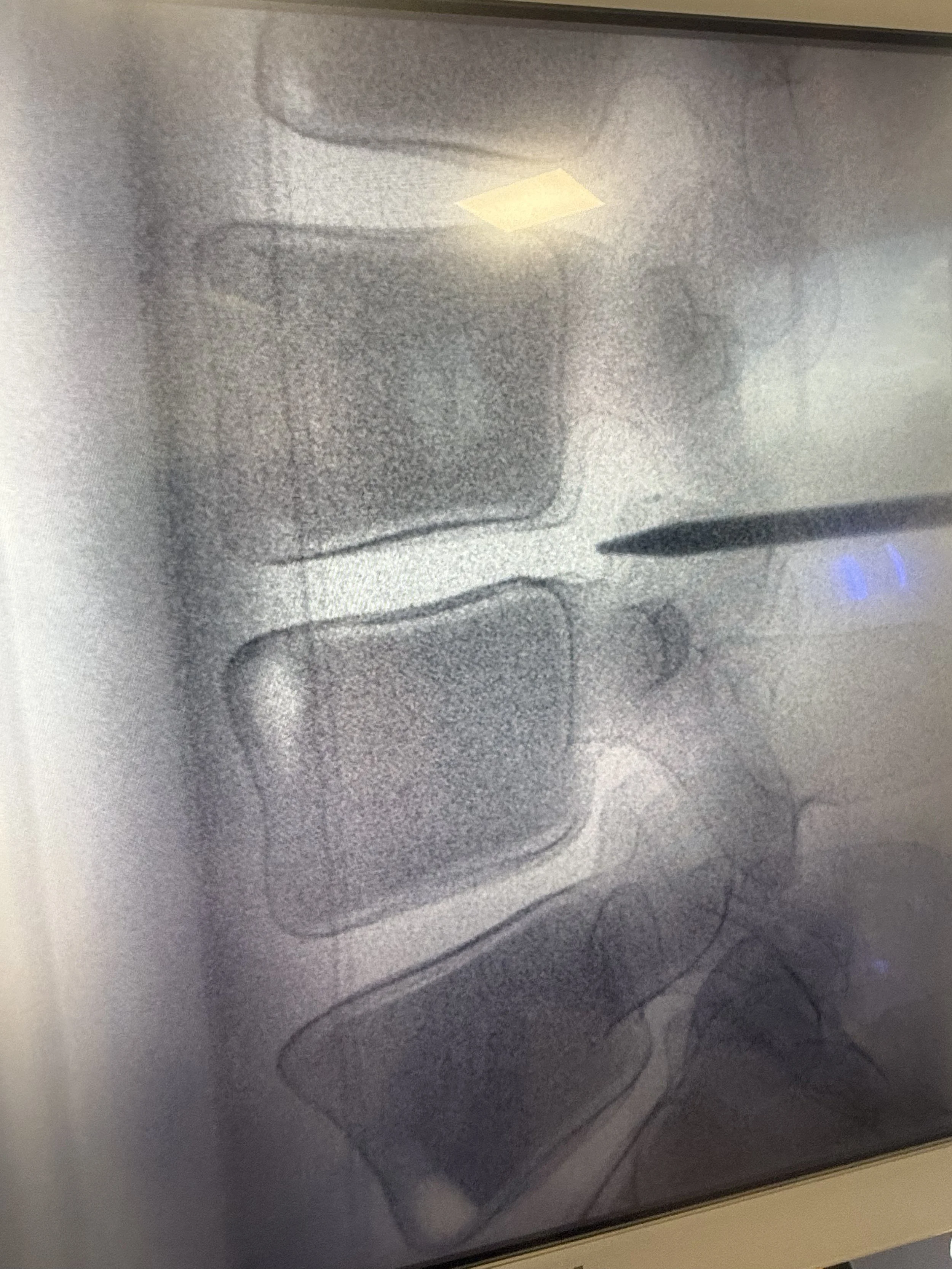 Thoracolumbar Spine - Degenerative Disc Disease — VIOMERSE