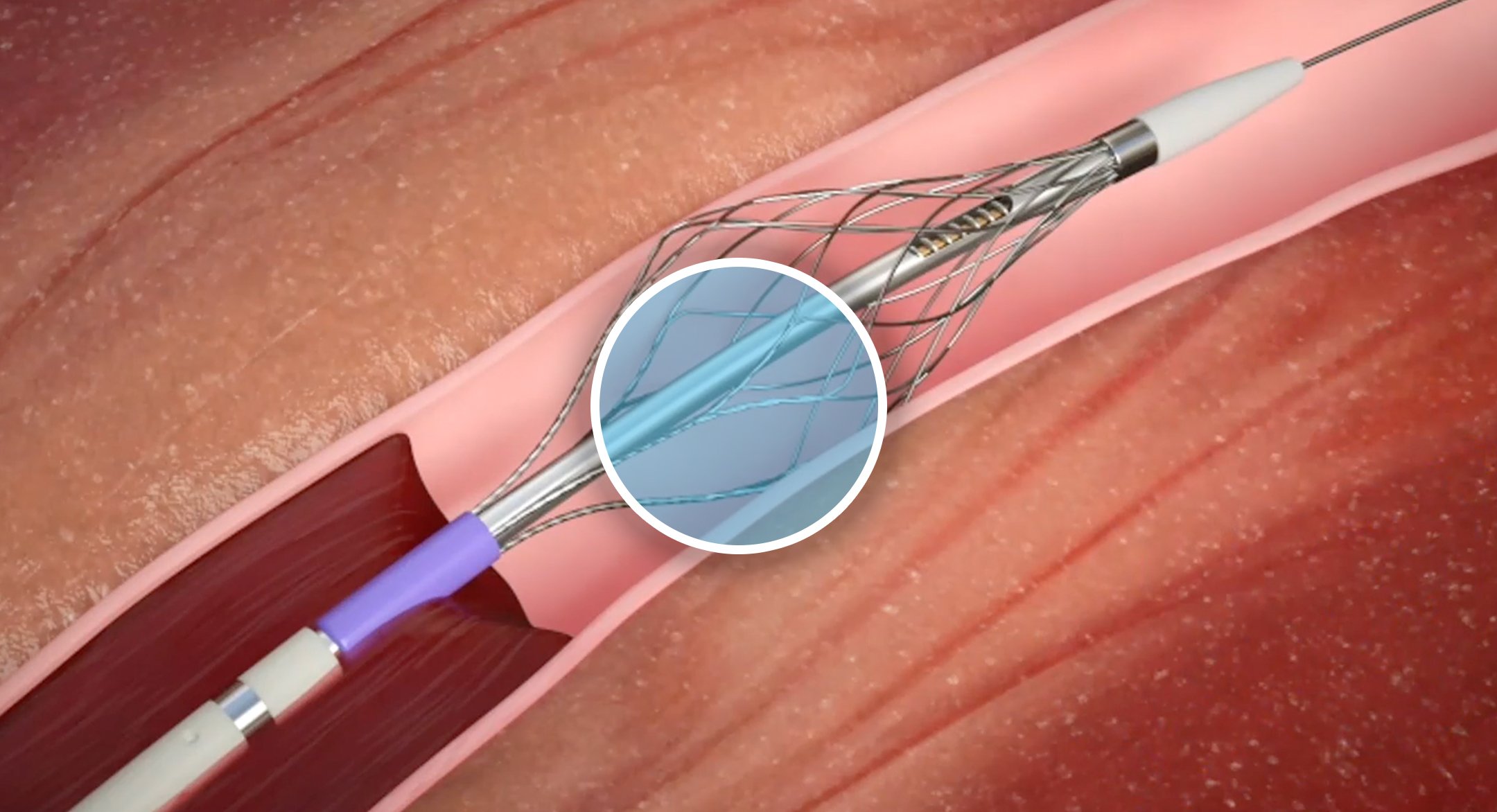 Pounce™ Thrombectomy System