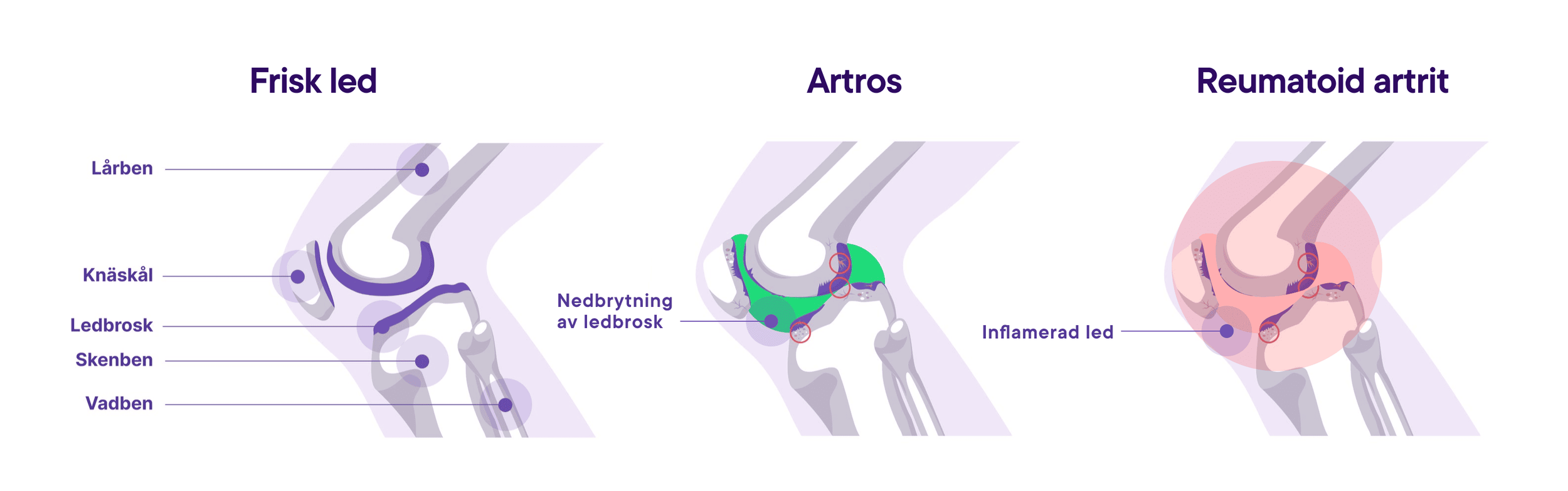 Vad är skillnaden mellan artris och artros? — Ledplastikcentrum