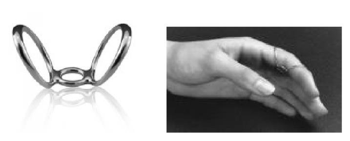 Finger Splints and Hyperextension — Atwal Clinic