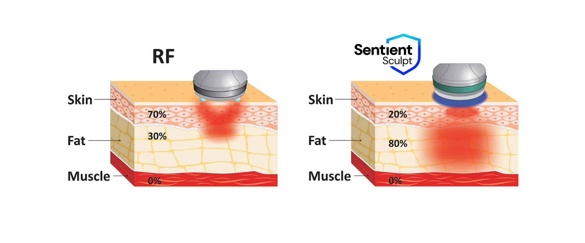 Sentient Sculpt™ Fat Reduction Treatment — Bafitis Plastic Surgery - Dr ...