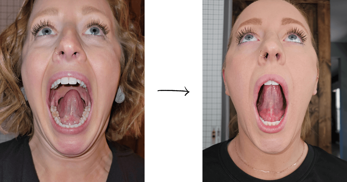 My Adult Tongue Tie Release: Symptoms, Providers, and Results — Balance ...