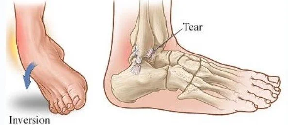 Ankle Sprain | Strain — Balance Chiro and Rehab | Denver Pregnancy ...
