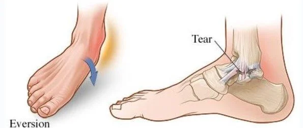 Ankle Sprain | Strain — Balance Chiro and Rehab | Denver Pregnancy ...