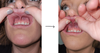 My Adult Tongue Tie Release: Symptoms, Providers, and Results — Balance ...
