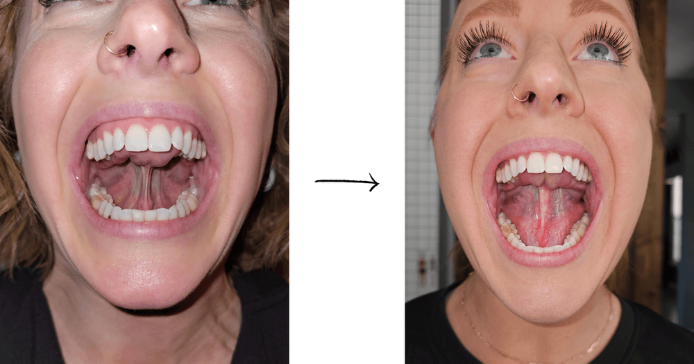 My Adult Tongue Tie Release: Symptoms, Providers, and Results — Balance ...