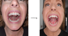 My Adult Tongue Tie Release: Symptoms, Providers, and Results — Balance ...