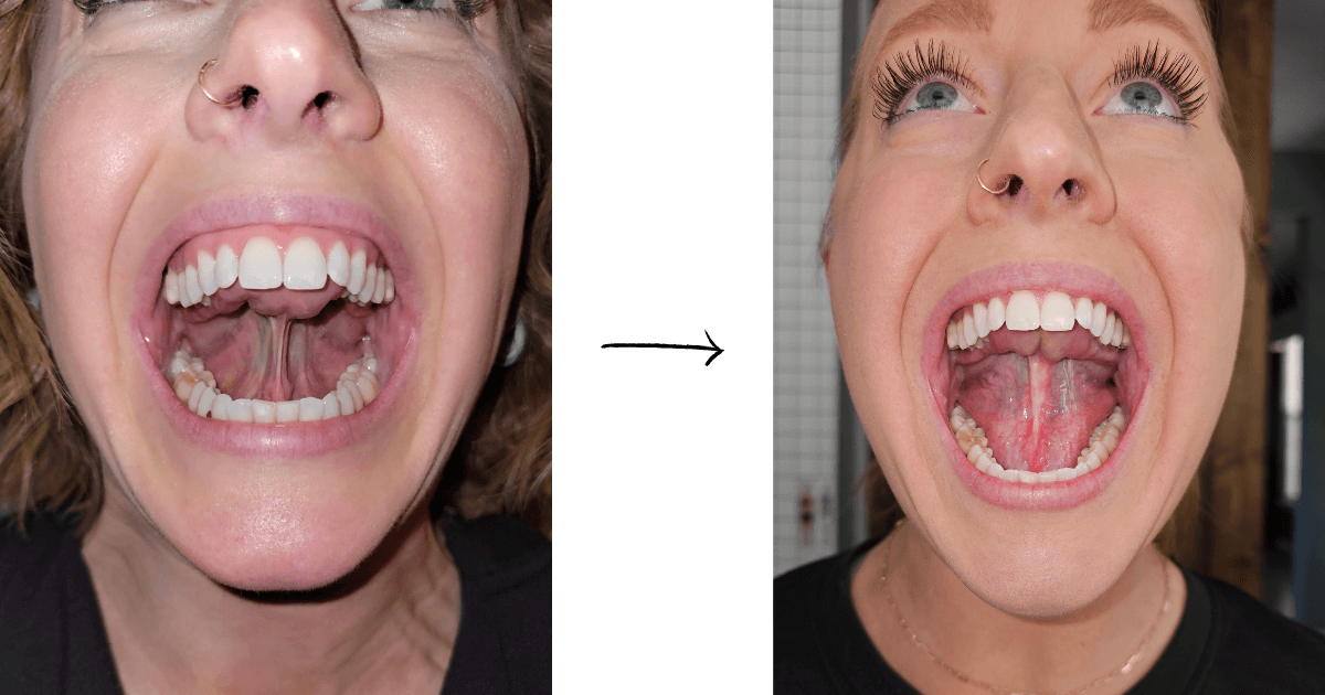 My Adult Tongue Tie Release: Symptoms, Providers, and Results — Balance ...