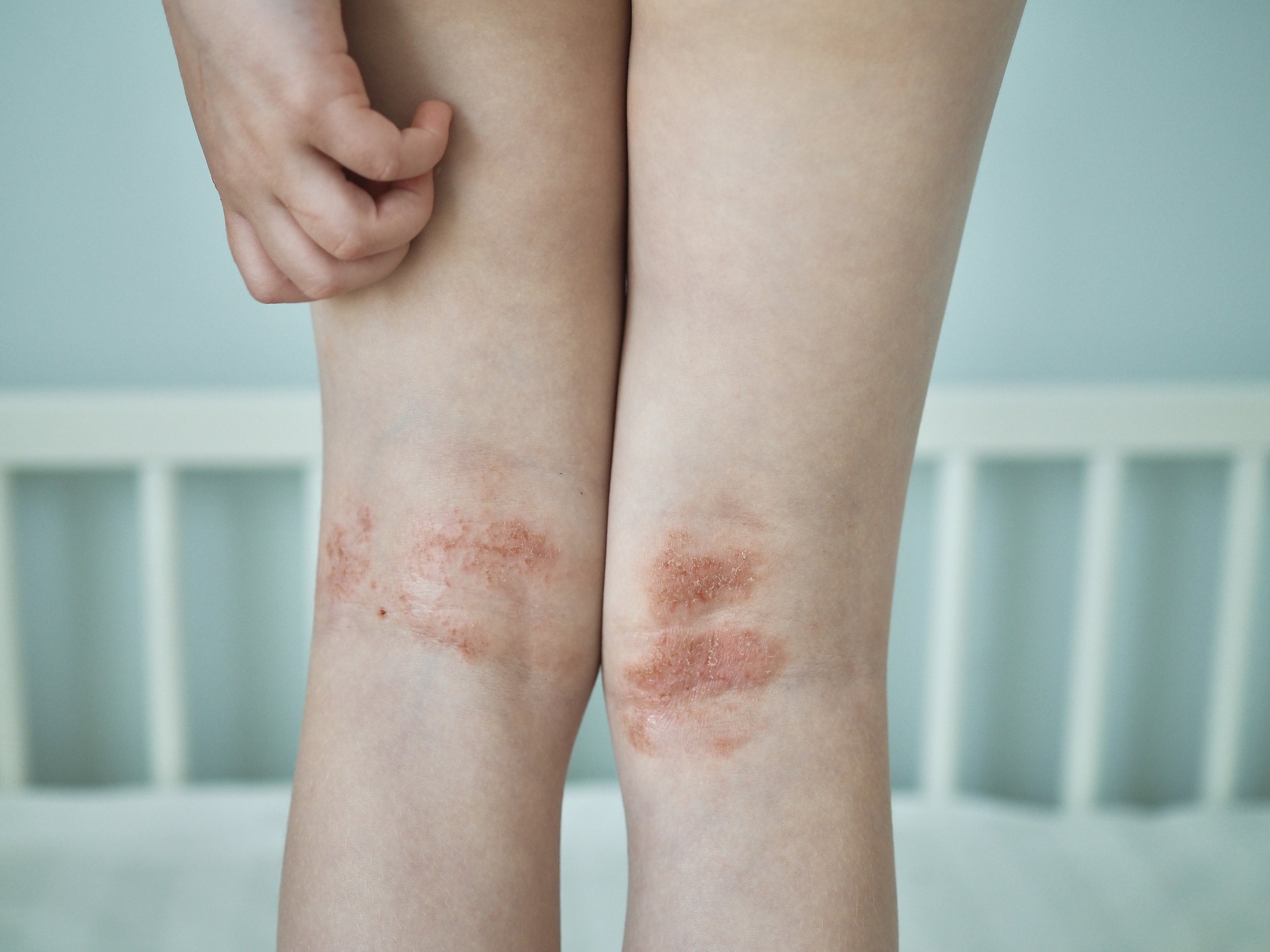 Atopic Dermatitis — Hunter Dermatology