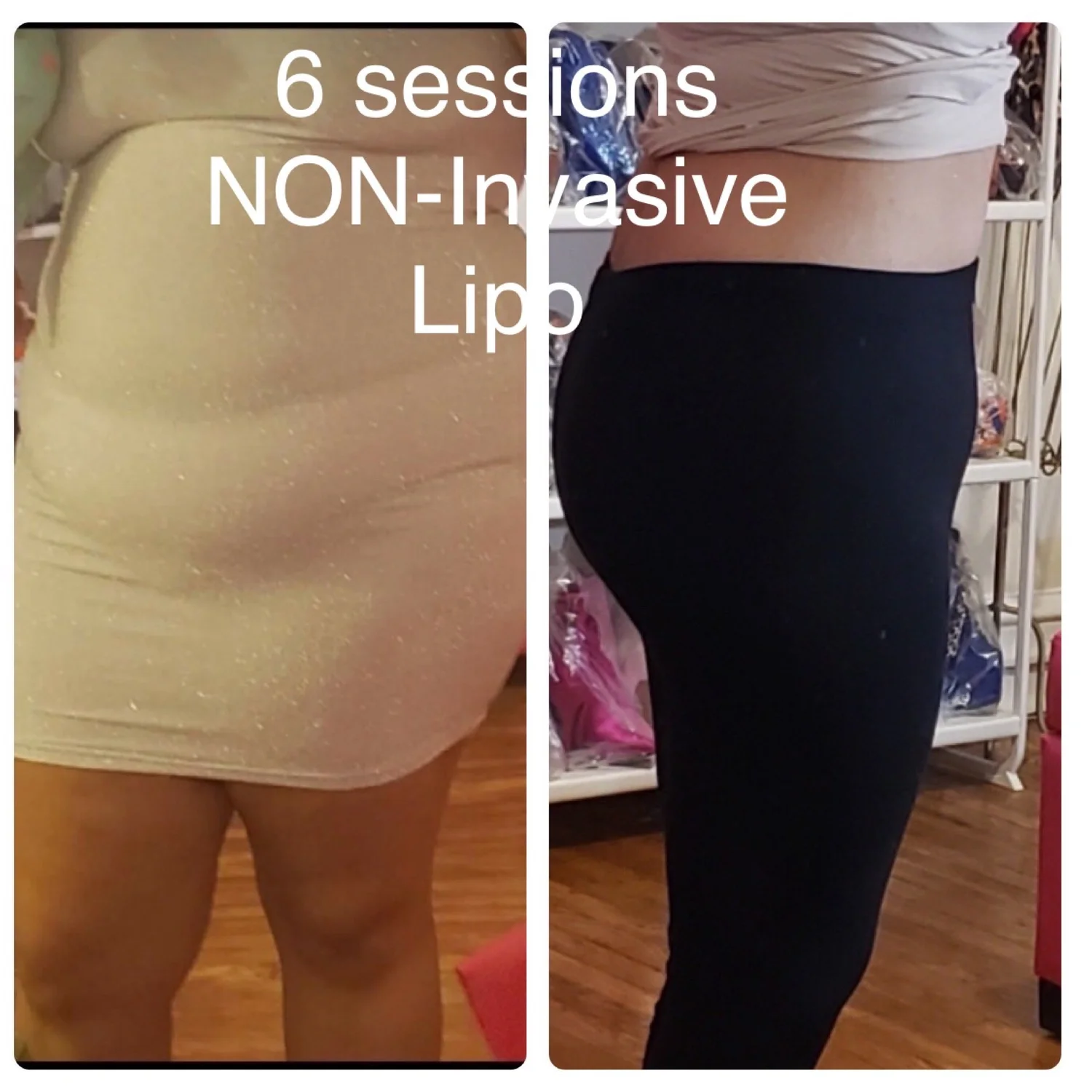 Non-Invasive Liposuction (NIR/IR Therapy) — Weight Loss Services in ...