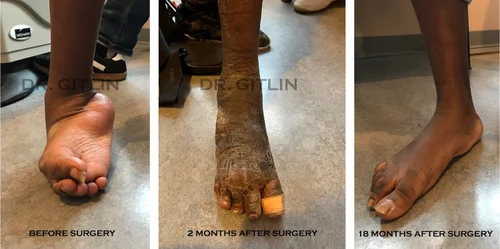 Clubfoot Reconstruction | Naples, Miami Florida & New York City