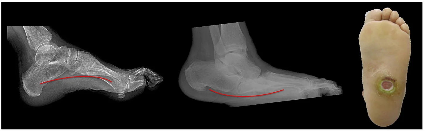 CHARCOT - Foot & Ankle Surgery