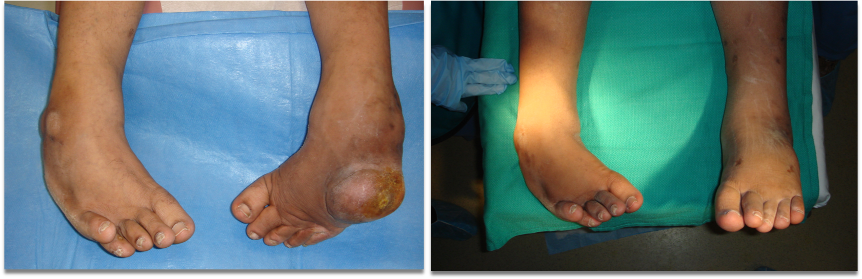Pioneers in the treatment of Complex Adult Clubfoot