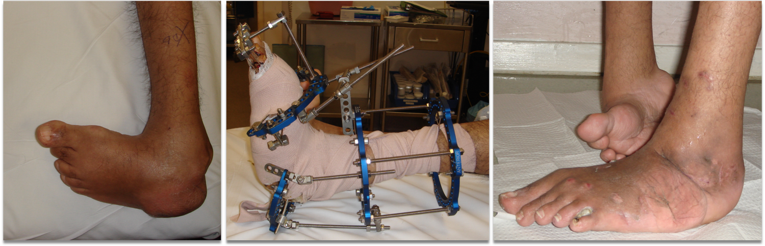 Clubfoot Reconstruction | Naples, Miami Florida & New York City