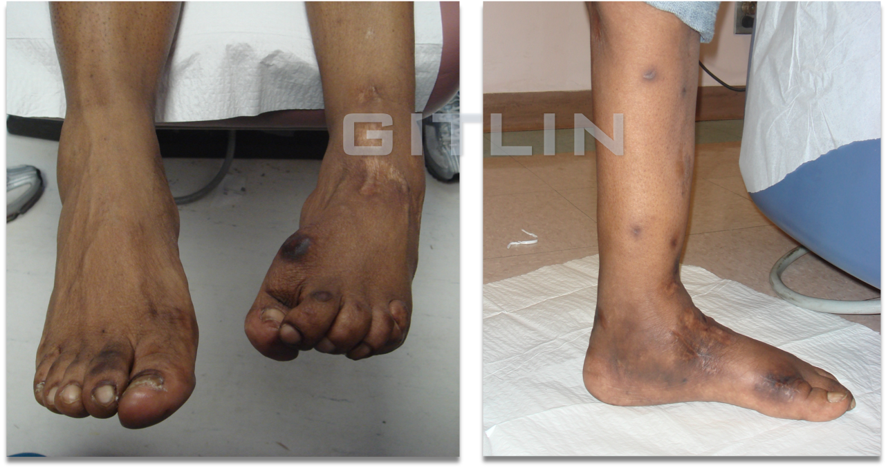 Pioneers in the treatment of Complex Adult Clubfoot