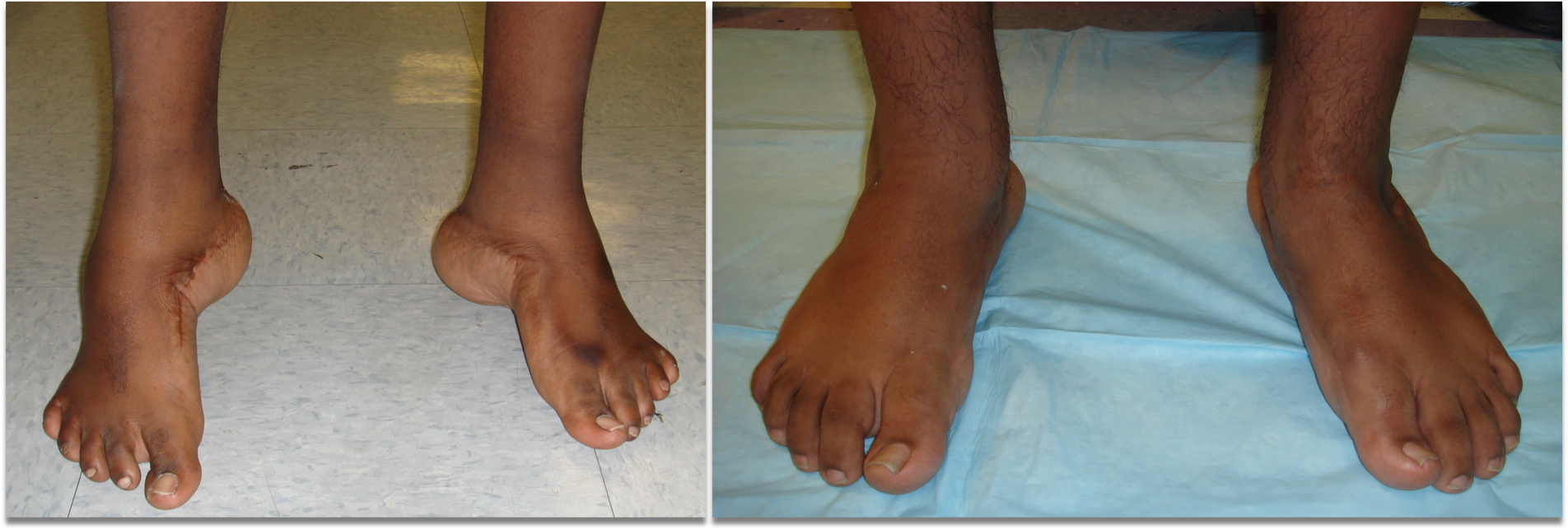 Pioneers in the treatment of Complex Adult Clubfoot